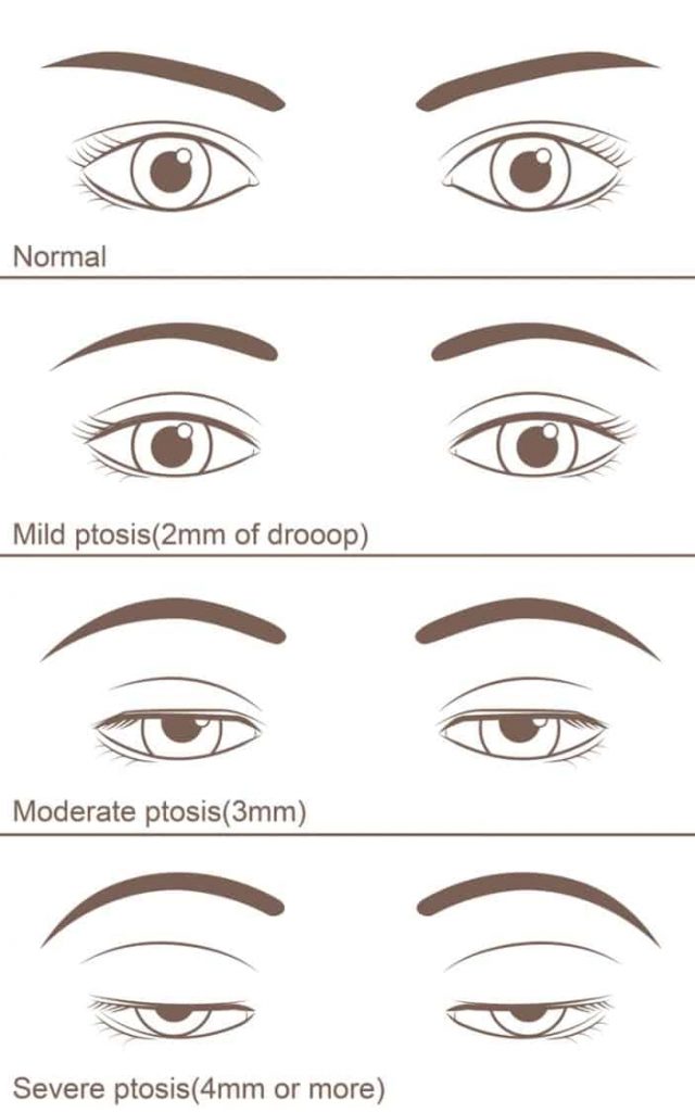 Ptosis Correction Without Surgery | Dream Plastic Surgery