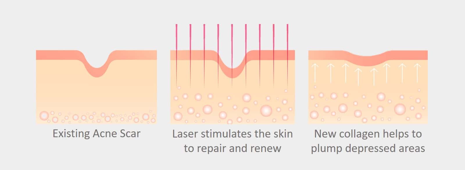 Acne Scar Treatment Singapore | Dream Plastic Surgery