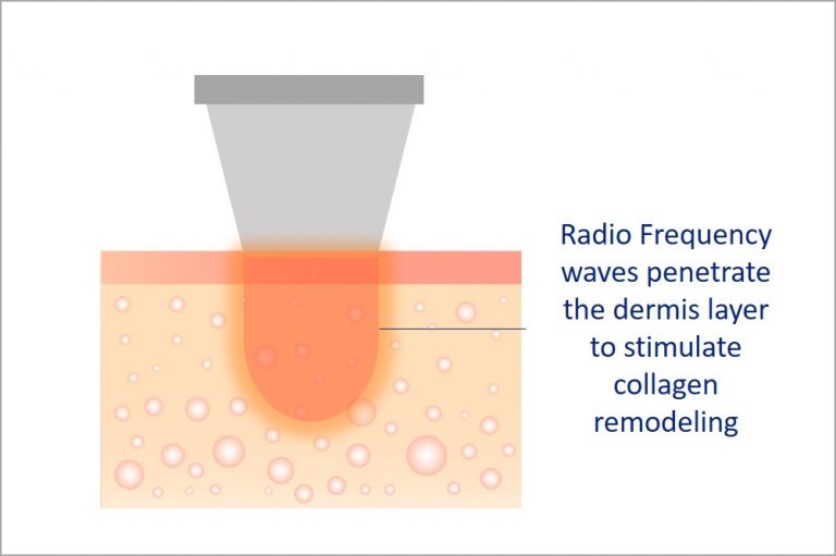 What To Expect from Your Thermage Treatments (Guide For First-Timers ...