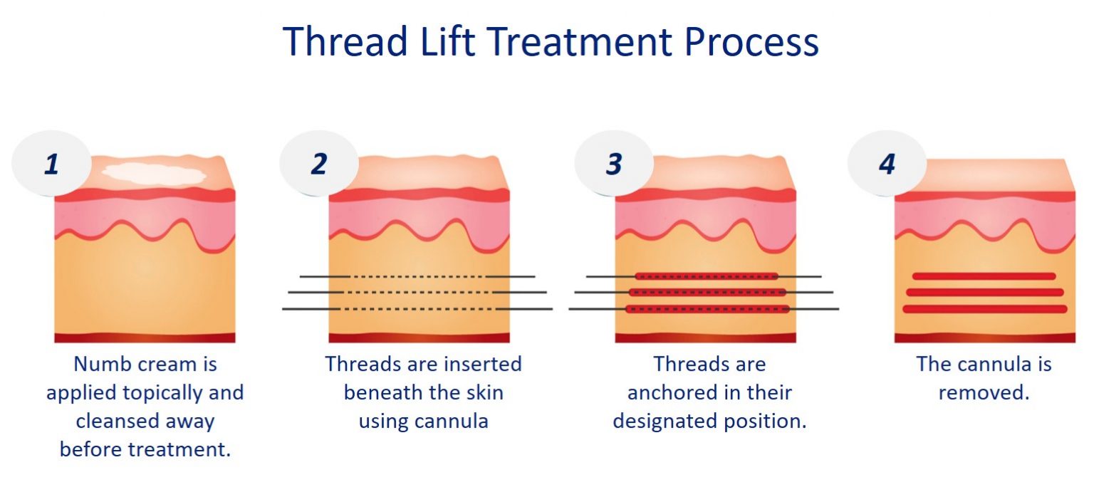 Face Thread Lift For V-Shape Face And Tighter Skin: How Does It Work ...