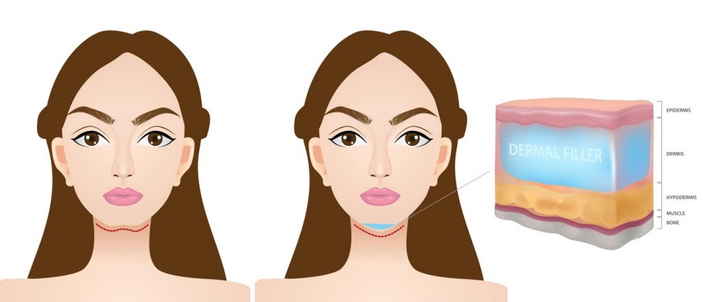 V-Shape Facial Contouring In Singapore - Everything You Need to Know ...