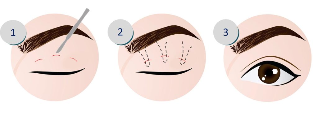 Guide To Droopy Eyelid (Ptosis) Treatment In Singapore | Dream Plastic ...