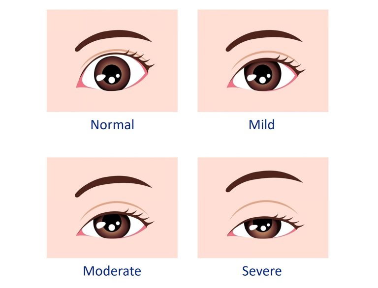 Guide To Droopy Eyelid (Ptosis) Treatment In Singapore | Dream Plastic ...