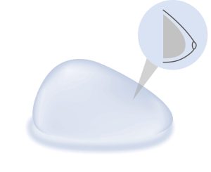 Breast Augmentation & Implants Surgery in Singapore | Dream Aesthetics