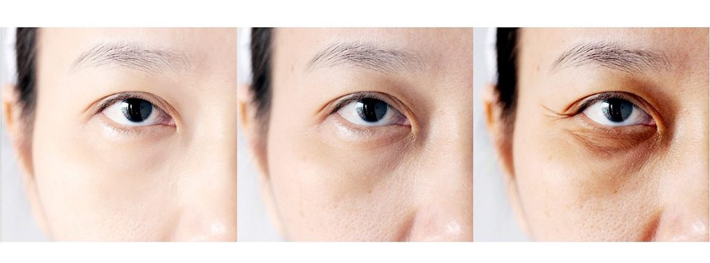 Non-Surgical Eye Bag Removal Procedure Based On Budget in Singapore