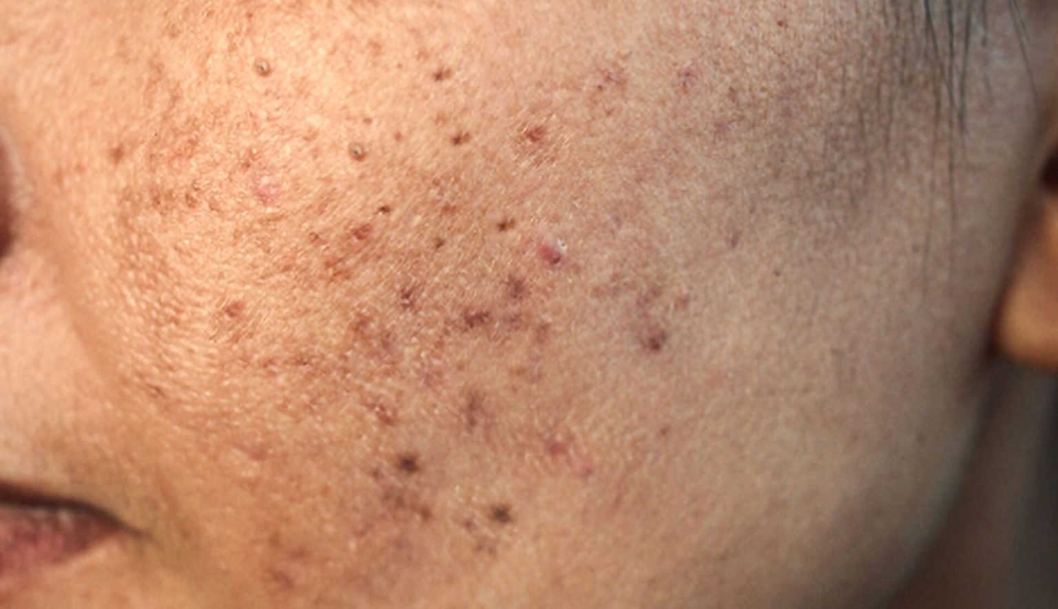 Pico Laser for Acne Scars in Singapore | Dream Plastic Surgery