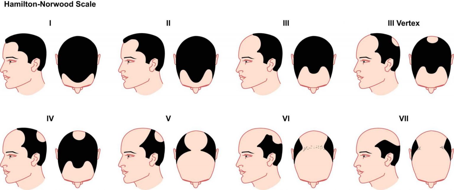 Hair Loss Treatment In Singapore - Dream Plastic Surgery