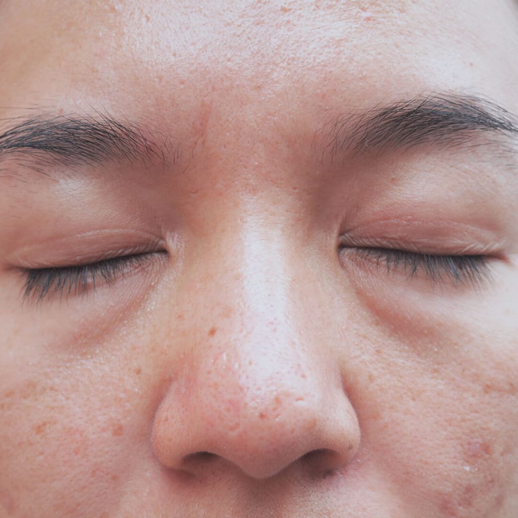 Fractional RF (FRF) Treatment | Dream Plastic Surgery