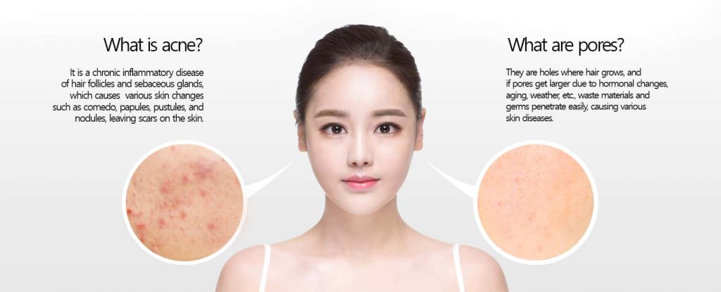 Pico Laser for Acne Scars in Singapore | Dream Plastic Surgery