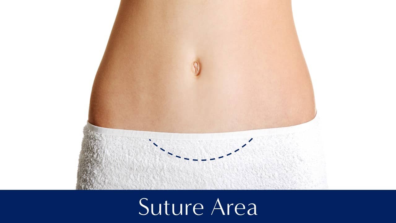 Tummy Tuck Surgery (Abdominoplasty) | Dream Plastic Surgery