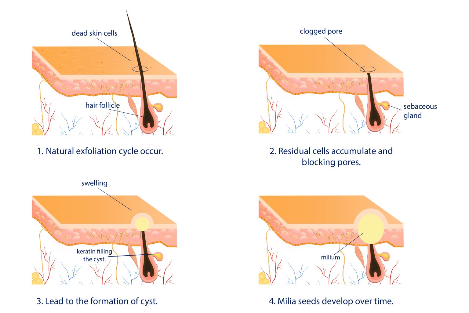 Struggling With Stubborn White Bumps? Here’s The Milia Seeds Removal ...