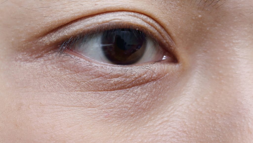 Don't Let Sunken Eyes Bother You; Here's How to Get Rid of Them | Dream ...