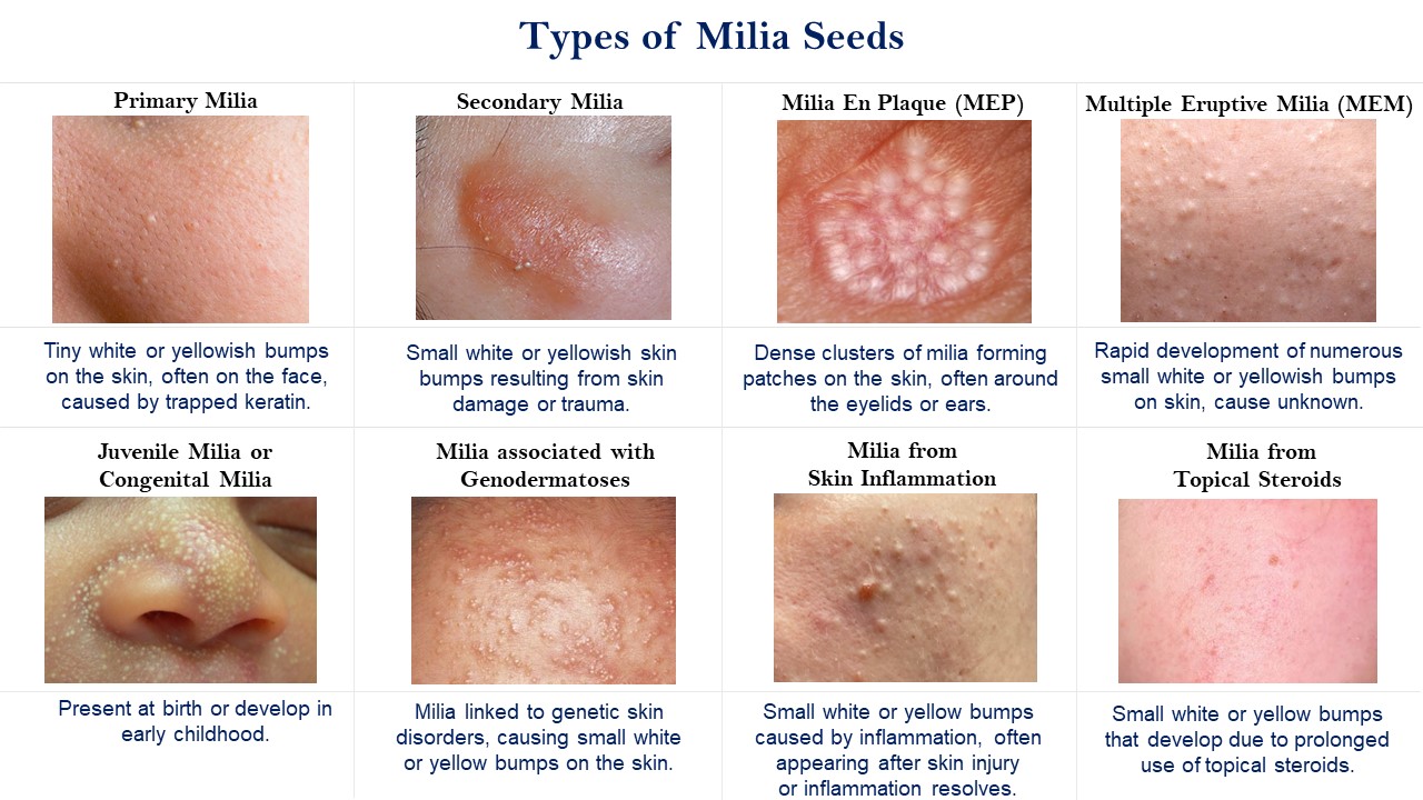Struggling With Stubborn White Bumps? Here’s The Milia Seeds Removal ...