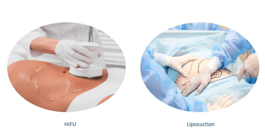 HIFU and Liposuction: Which One Is Ideal Procedure To Contour Your Body ...