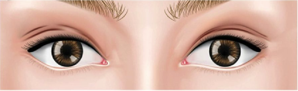 Double Eyelid Stitching & Lift Singapore | Dream Plastic Surgery