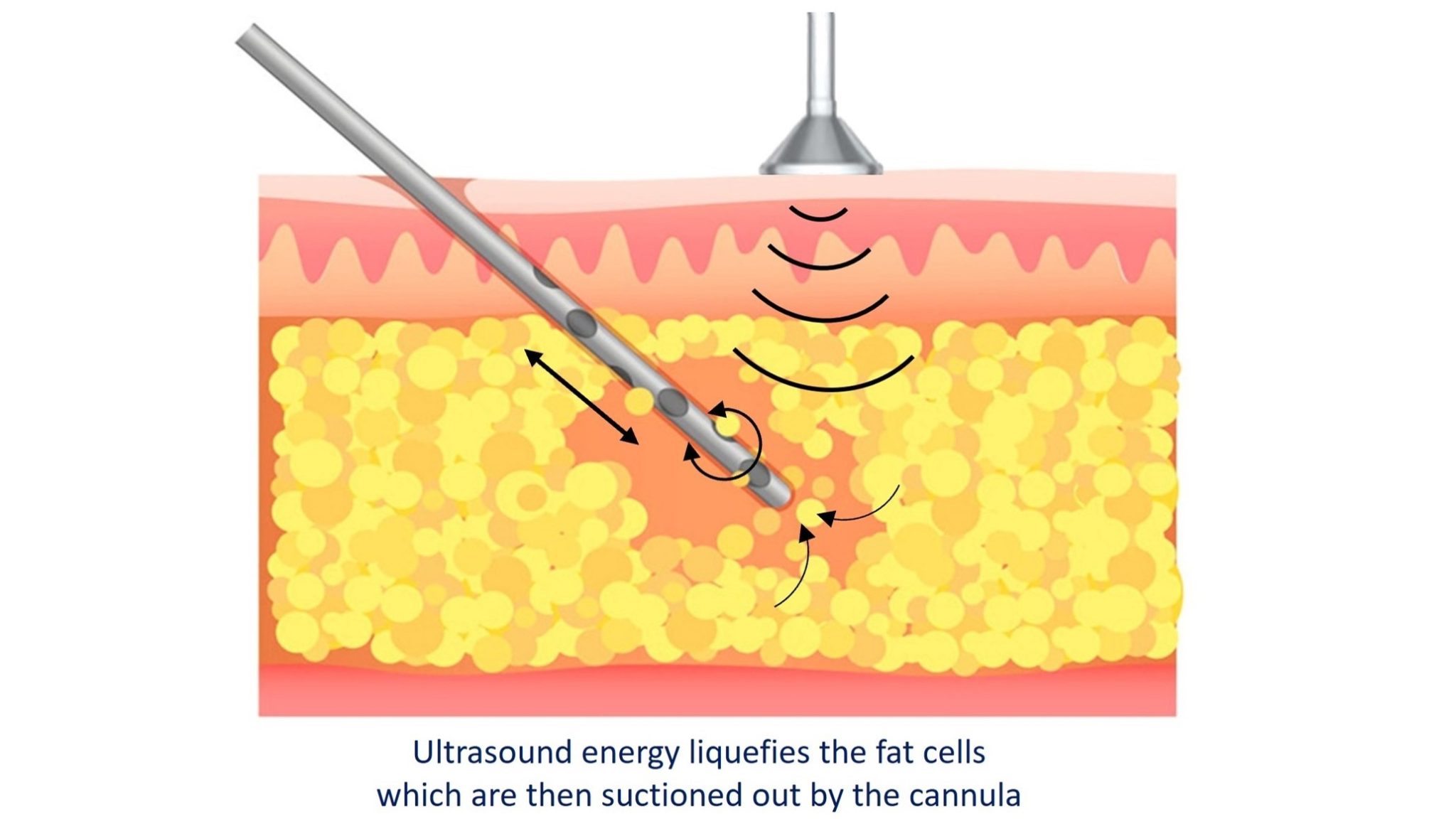 All About Liposuction in Singapore | Dream Plastic Surgery